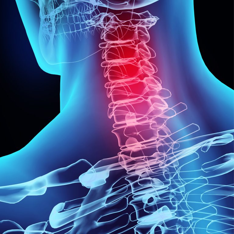 Nekpijn - Helpt een brace? - Hoe kies je de juiste brace? - Bracewijzer